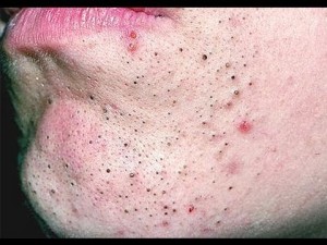 5 Ways To Get Rid Of Deep Blackheads Fast - HowHunter