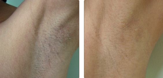 10 Ways To Get Rid Of Dark Underarms Fast - HowHunter
